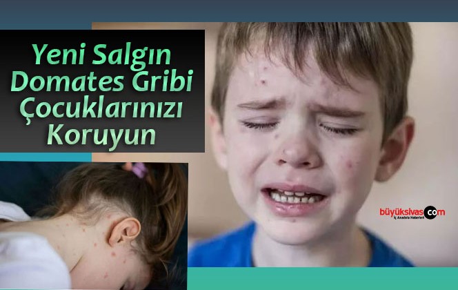 Yeni Salgın Domates Gribi! En çok çocukları vuruyor hızlı bulaşıyor ...